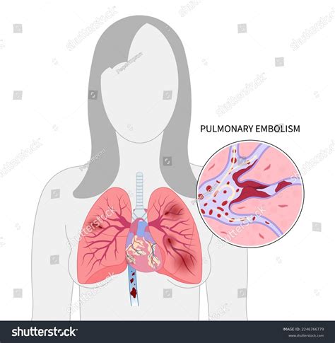 Thromboembolism Over 173 Royalty Free Licensable Stock Vectors
