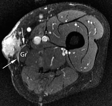 Soft Tissue Infections And Their Imaging Mimics From Cellulitis To