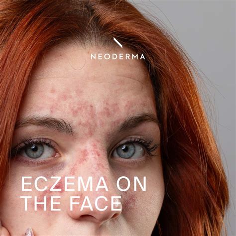 Eczema On Face Images Eczema Atopic Dermatitis Condition Treatments