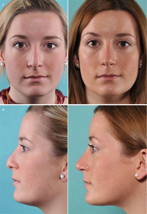 Tip Refinement In Secondary Rhinoplasty Plastic Surgery Key
