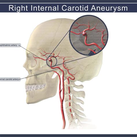 Medical Legal Exhibits Legal Animations And Trial Graphics Tria