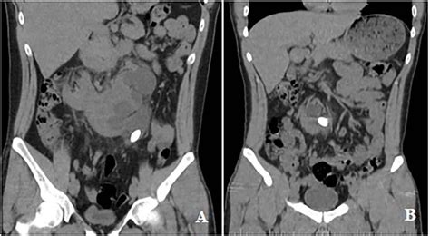 Ct Images Ct Showed Moved Stone In The Left Renal Pelvis Download Scientific Diagram