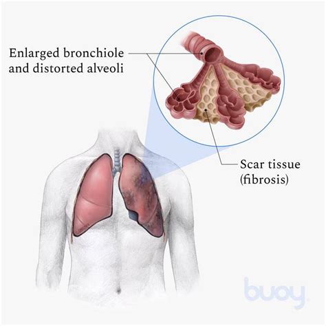 Cystic Fibrosis Lungs Vs Healthy Lungs Cystic Fibrosis Lungs Vs Healthy Lungs