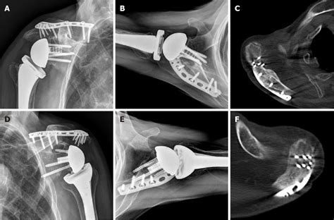Plain Radiographs And Computed Tomography Scan At 2 Years After Plate Download Scientific