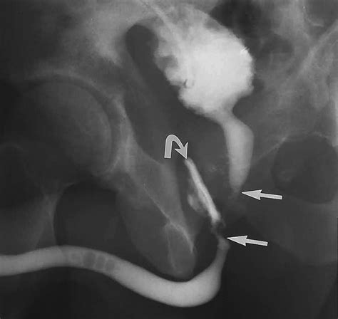 Imaging Of Urethral Disease A Pictorial Reviewradiographics
