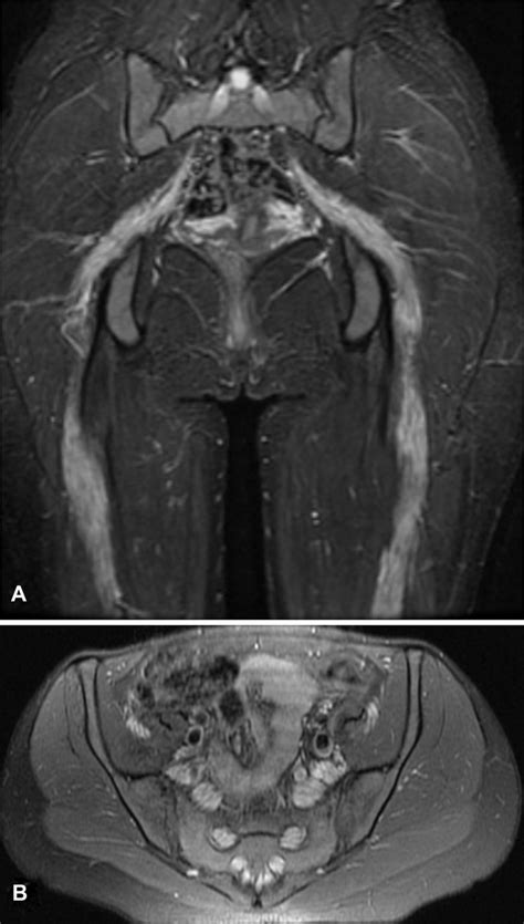 Lumbar Plexus Mri Protocol