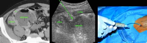 The Radiology Assistant Appendicitis Us Findings The Radiology Assistant Appendicitis Us Findings