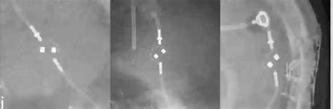 Sophysa Sophy Mini Sm8 Shuntsystem Ars Neurochirurgica