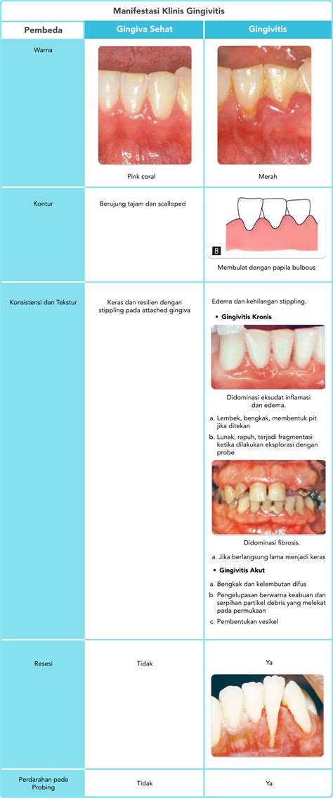 Gingivitis Gingival Enlargement Pembesaran Gingiva