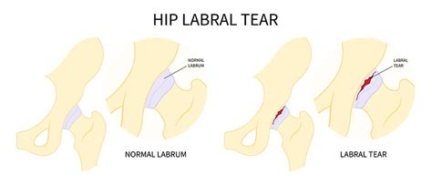 Femoroacetabular Impingement Injection Musculoskeletal Ultrasound