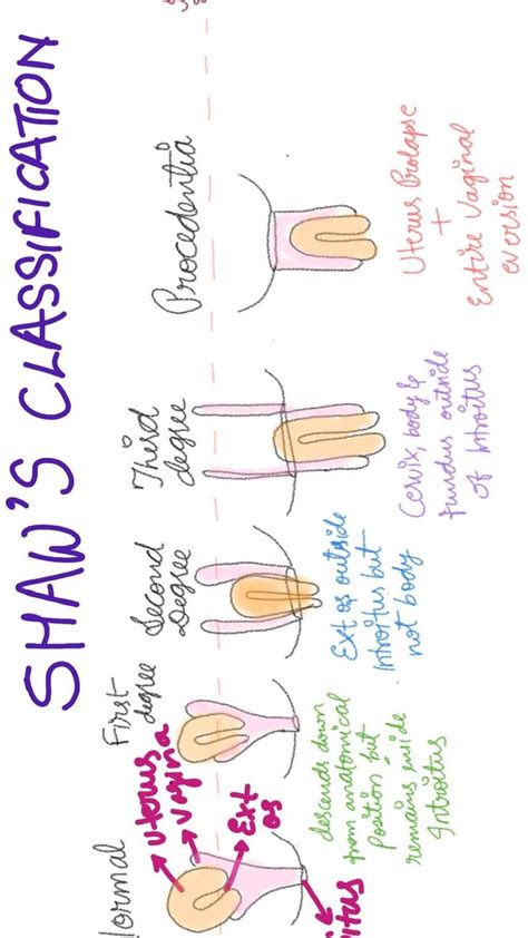 Uterine Prolapse Shaws Classification Doctor Who Memes Doctors