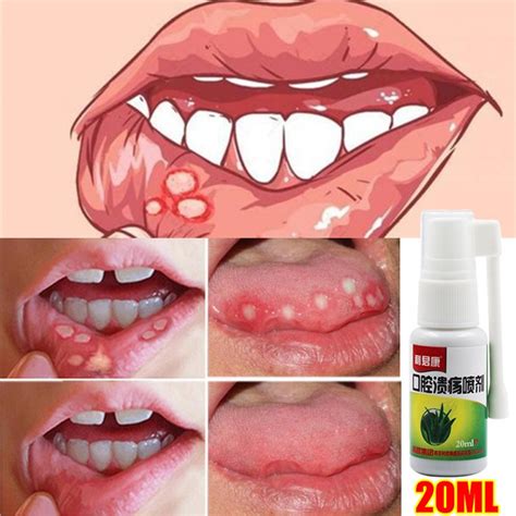 1pc 20ml Propolis Anti Bacterial Treatment Hygiene Mouth Ulcer Pain
