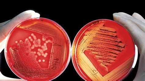 Staphylococcus Aureus Toxin Found In Montgomery Daycare Illness Investigation