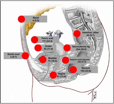 Diagnostics And Surgical Treatment Of Deep Endometriosis—real World