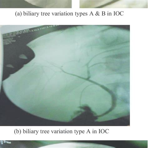Biliary Tree Variation Types E1 And E2 In Ioc Download Scientific