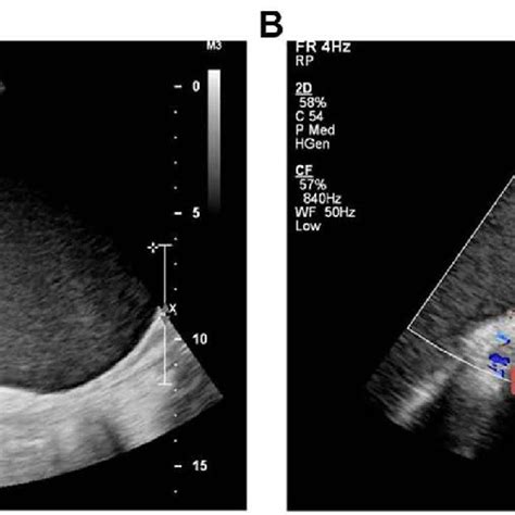 Abdominal Ultrasound Scan Showed There Was A Huge Mass In The Pelvic