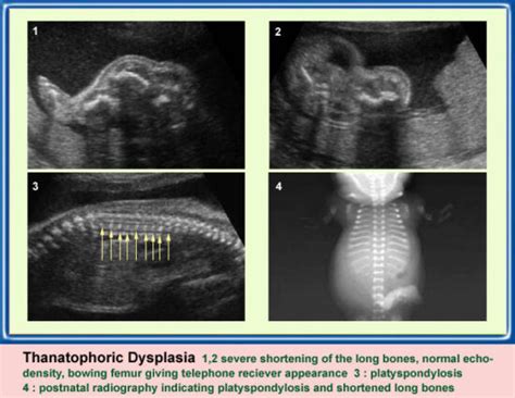 Thanatophoric Dysplasia Department Of Obstetrics And Gynecology