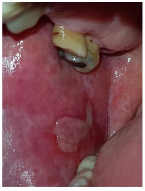 Oral Lichen Planus Clinical Presentation Demographic Characteristics