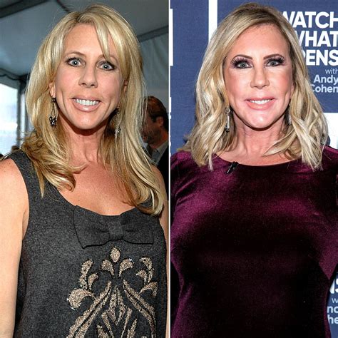 Before And After Plastic Surgery Gone Wrong