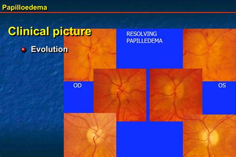 Papilloedema Ppt