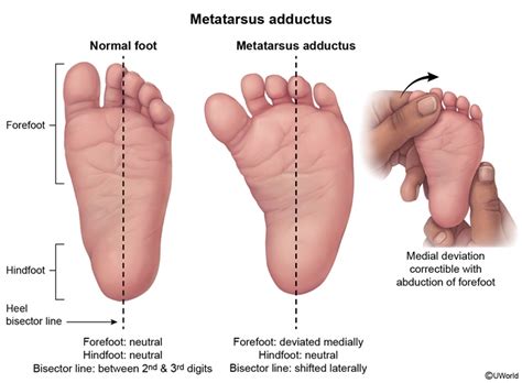 Congenital Clubfoot Congenital Talipes Equinovarus Rheumatology
