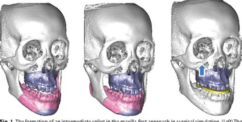 Figure 1 From Accuracy Of Mandible First Versus Maxilla First Approach