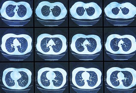 Lung Cancer Cat Scan