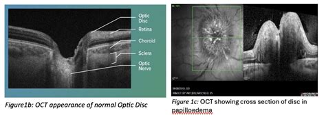 Papilloedema Mind The Bleep
