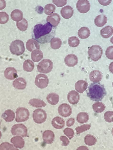 Large Platelets On Smear