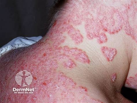Facial Psoriasis Images