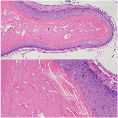Pilar Cyst Histology Ulcerated Nodule On The Scalp Mdedge
