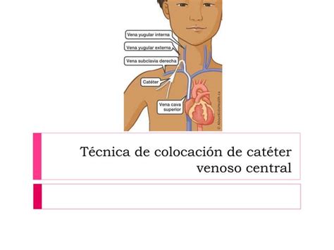 Técnica De Colocación De Catéter Venoso Central Pptx