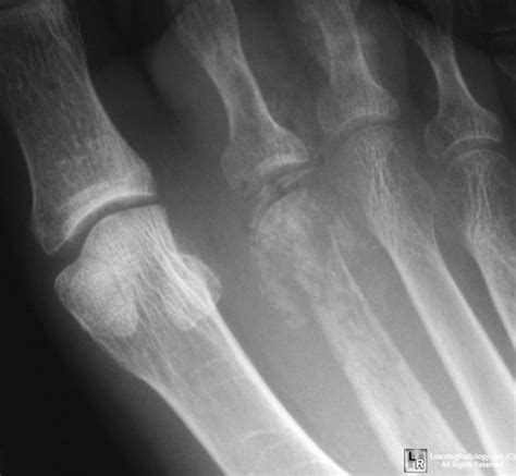Osteomyelitis X Rays Osteomyelitis Clinical Features Investigations
