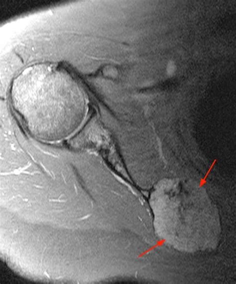 Chondroid Lesions Radsource