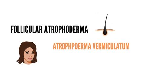 Follicular Atrophoderma Atrophoderma Vermiculatum Keratosis Pilaris