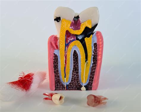 Premium Photo Decayed Root Tooth Is Removed Caries And Tooth