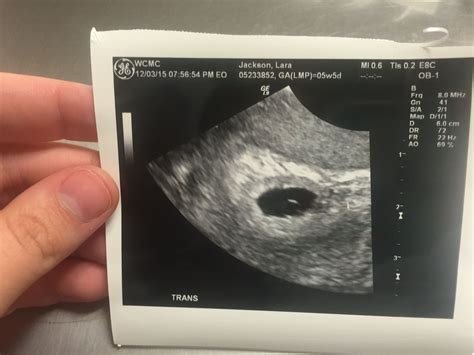 5 Weeks Pregnant Sonogram Moovari