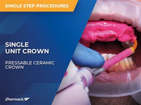 Zhermack Dental Clinical Procedure For Complete Removable Prosthesis Zhermack Educational Hub