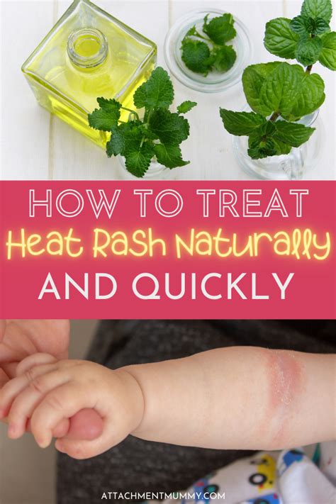 How To Treat Heat Rash Between Legs At Nicholas Warrior Blog