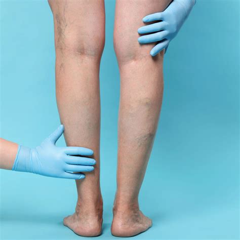 Laser Atherectomy A Development In Pad Treatment