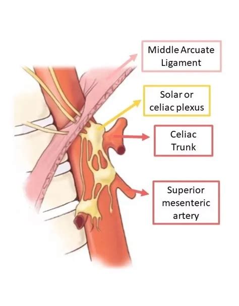 Median Arcuate Ligament Syndrome Mals A Hypermobile Dietitians
