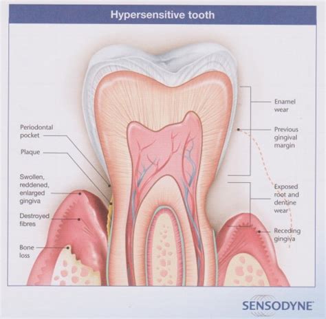 Tooth Sensitivity
