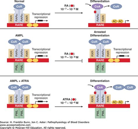 Acute Leukemias Basicmedical Key