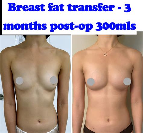 Small Breast Implants Uk