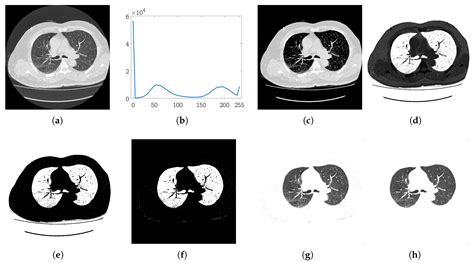 Lung Nodule Detection In Ct Images Using Statistical And Shape Based