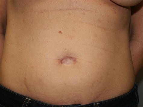 Belly Button Surgery Before And After Washington Dc Davinci