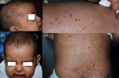 Clinical Photographs Of The Patient A Yellow Scaly Papules Of The