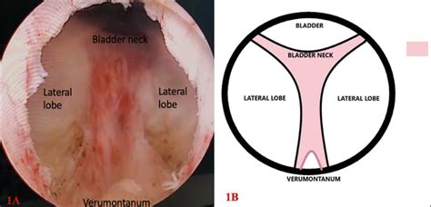 Evaluating Outcomes Of Combined Bladder Neck And Supramontanal Sparing