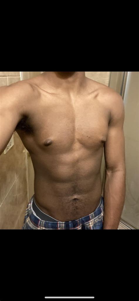 Is This Gyno R Gynecomastia