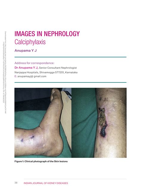 Pdf Calciphylaxis